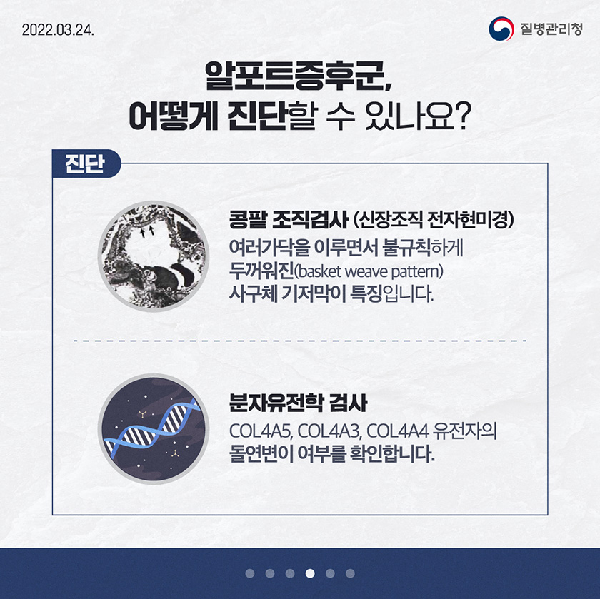신장을 망가뜨리는 희귀질환 알포트증후군 이달의건강소식 알림·자료 질병관리청